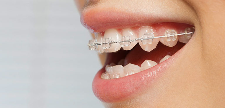 Brackets estéticos - Rio Clínica - Otorrino, Oftalmologia e Ortodontia